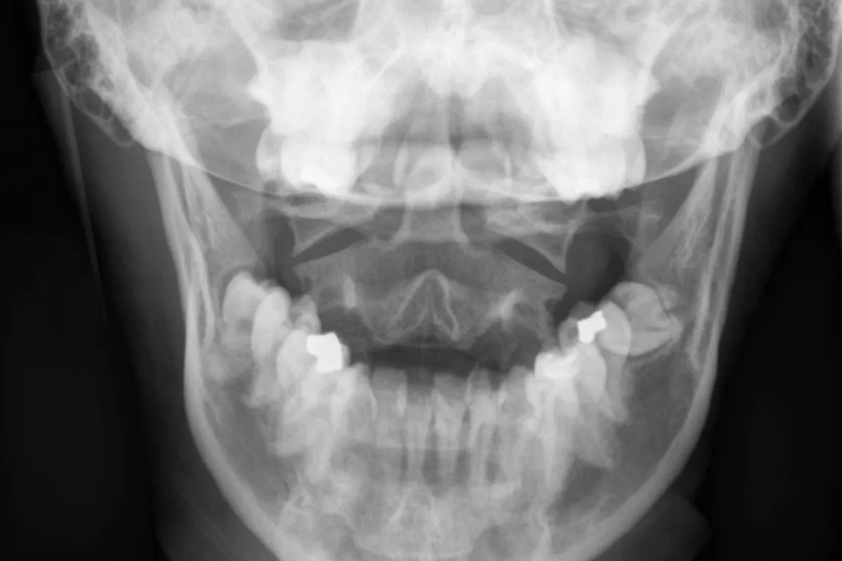 Jaw Bone Health Indio CA, La Quinta | Teeth & Jaw Health